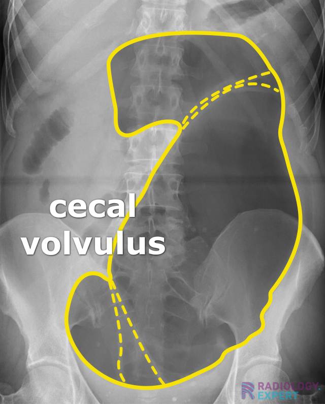 Sigmoid Volvulus Mri